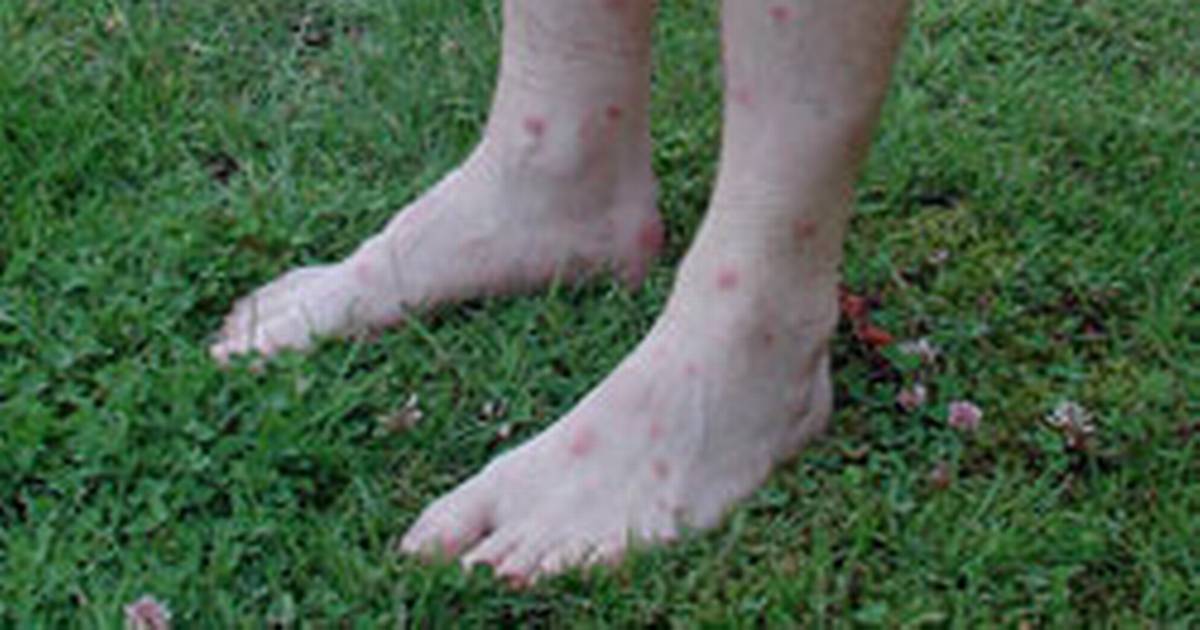 Gennemborer huden og dør: Parasitiske fladorme generer badegæster i ...