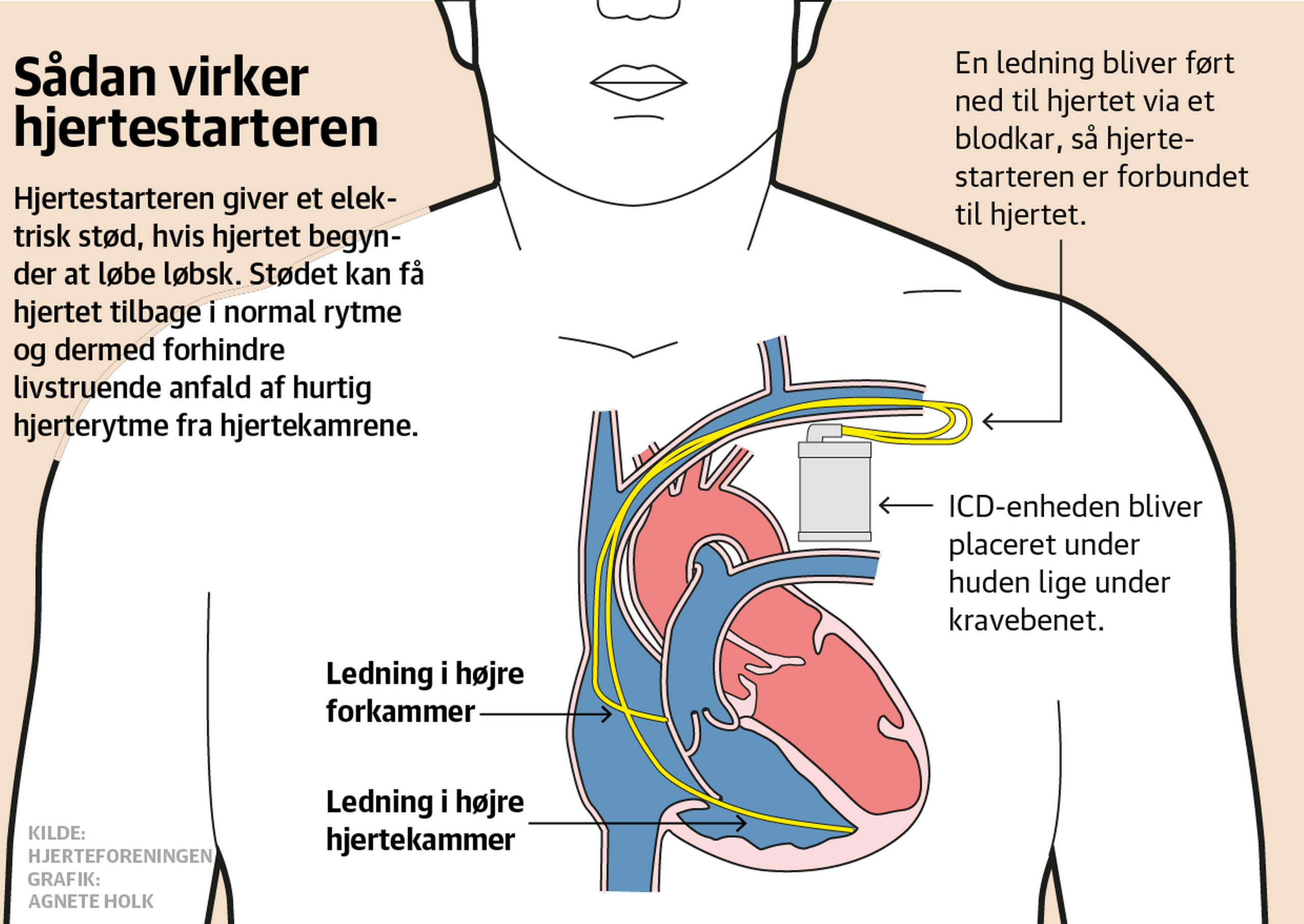 Hjertelæge: Pacemaker behøver ikke begrænse Eriksen - Jyllands-Posten