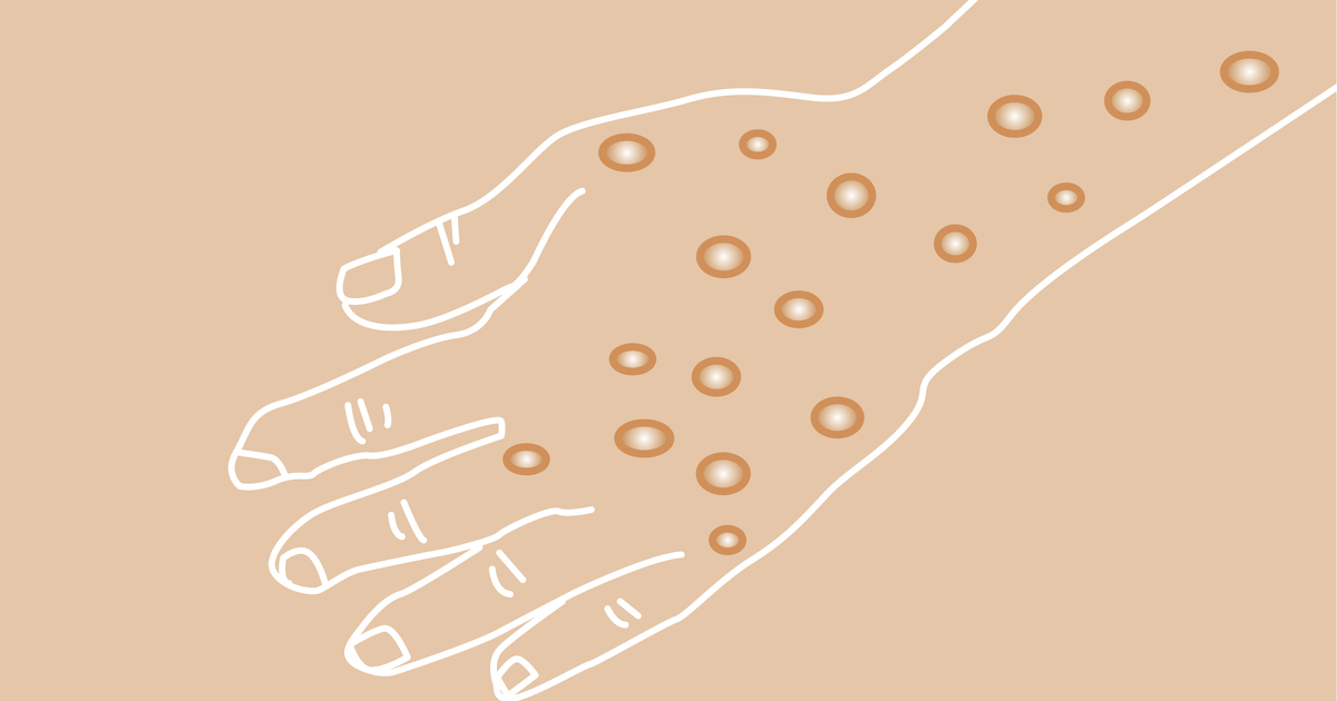 WHO registrerer over 1000 tilfælde af abekopper uden for Afrika ...