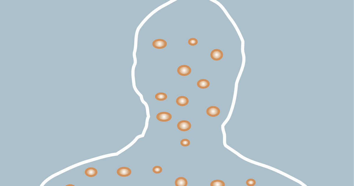 Danmark har købt yderligere 10.000 vacciner mod abekopper - Jyllands-Posten