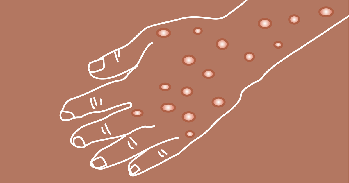 Dansk kvinde har fået abekopper - Jyllands-Posten