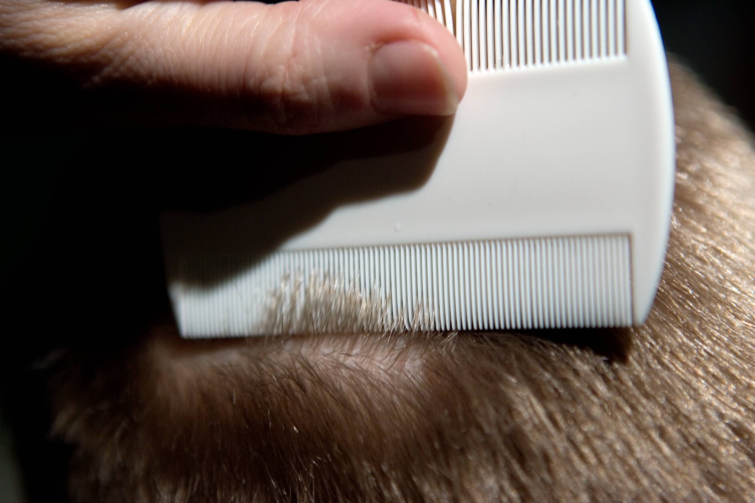 Tid til lusetjek: Lus gør comeback efter coronaårene - Jyllands-Posten