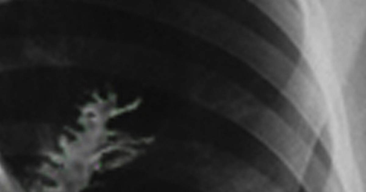 Levede i årevis med grangrene i lungerne