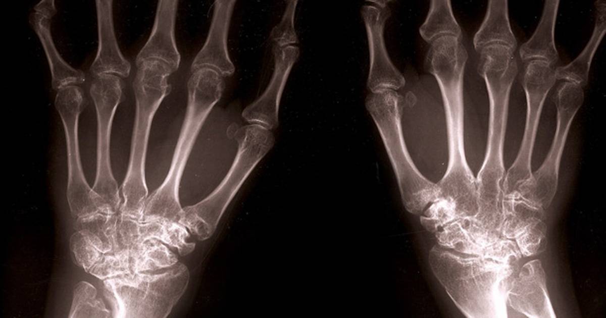 Skøre knogler bliver ikke behandlet